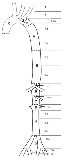 Thoracic Endovascular Aortic Repair (TEVAR) First in Patients with ...