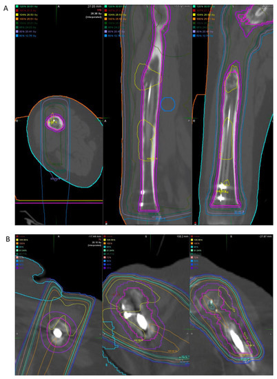Carbon Fiber Implants in Orthopaedic Oncology