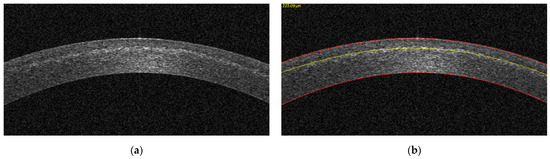 JCM | Free Full-Text | Demarcation Line Depth in Epithelium-Off Corneal ...