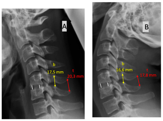 Reliability and Utility of Various Methods for Evaluation of Bone Union ...