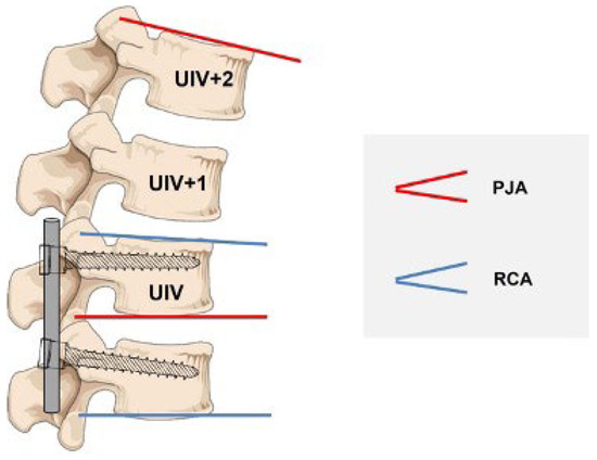 Risk Factors of Proximal Junctional Kyphosis in Adolescent Idiopathic ...