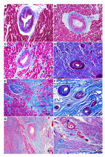 Microvascular Dysfunction in Hypertrophic Cardiomyopathy