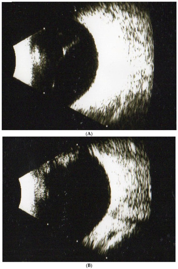 A New Pharmacological Vitreolysis through the Supplement of Mixed Fruit ...