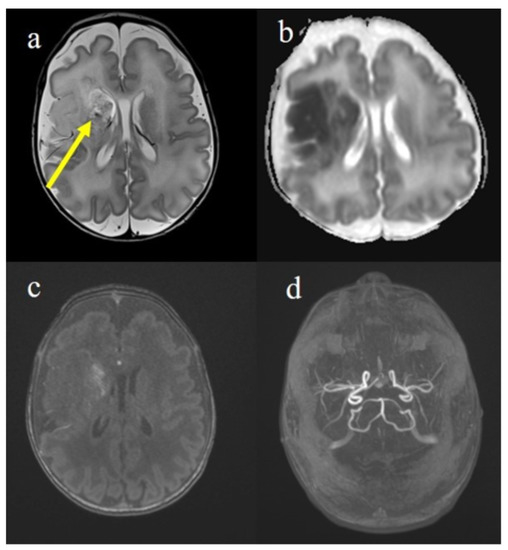 Perinatal Cerebral Ischemic Lesion and SARS-CoV-2 Infection during Pregnancy: A Case Report and ...