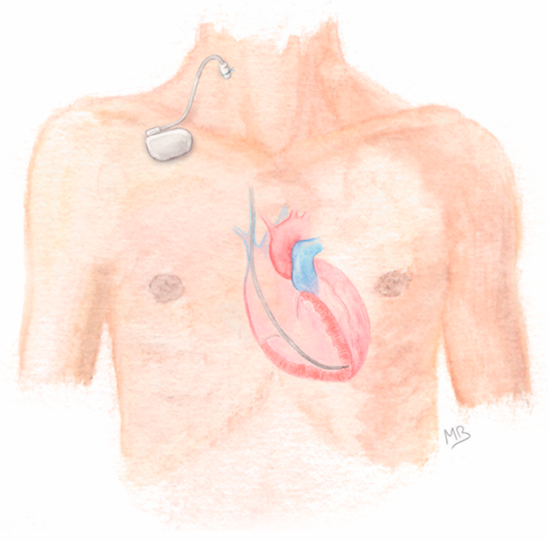 Externalized Reusable Permanent Pacemaker For Prolonged Temporary Externalized Reusable Permanent Pacemaker For Prolonged Temporary