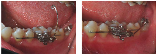 JCM | Free Full-Text | Bone Modeling after Orthodontic Extrusion: A ...