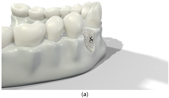 JCM | Free Full-Text | Risk Factors for Complications Following Staged ...