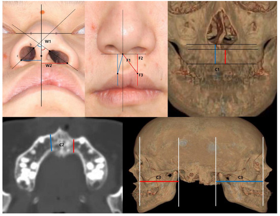 The Concordance of Alveolar Bone Deficiency with Severity of Lip ...