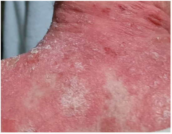 The Intriguing Links between Psoriasis and Bullous Pemphigoid