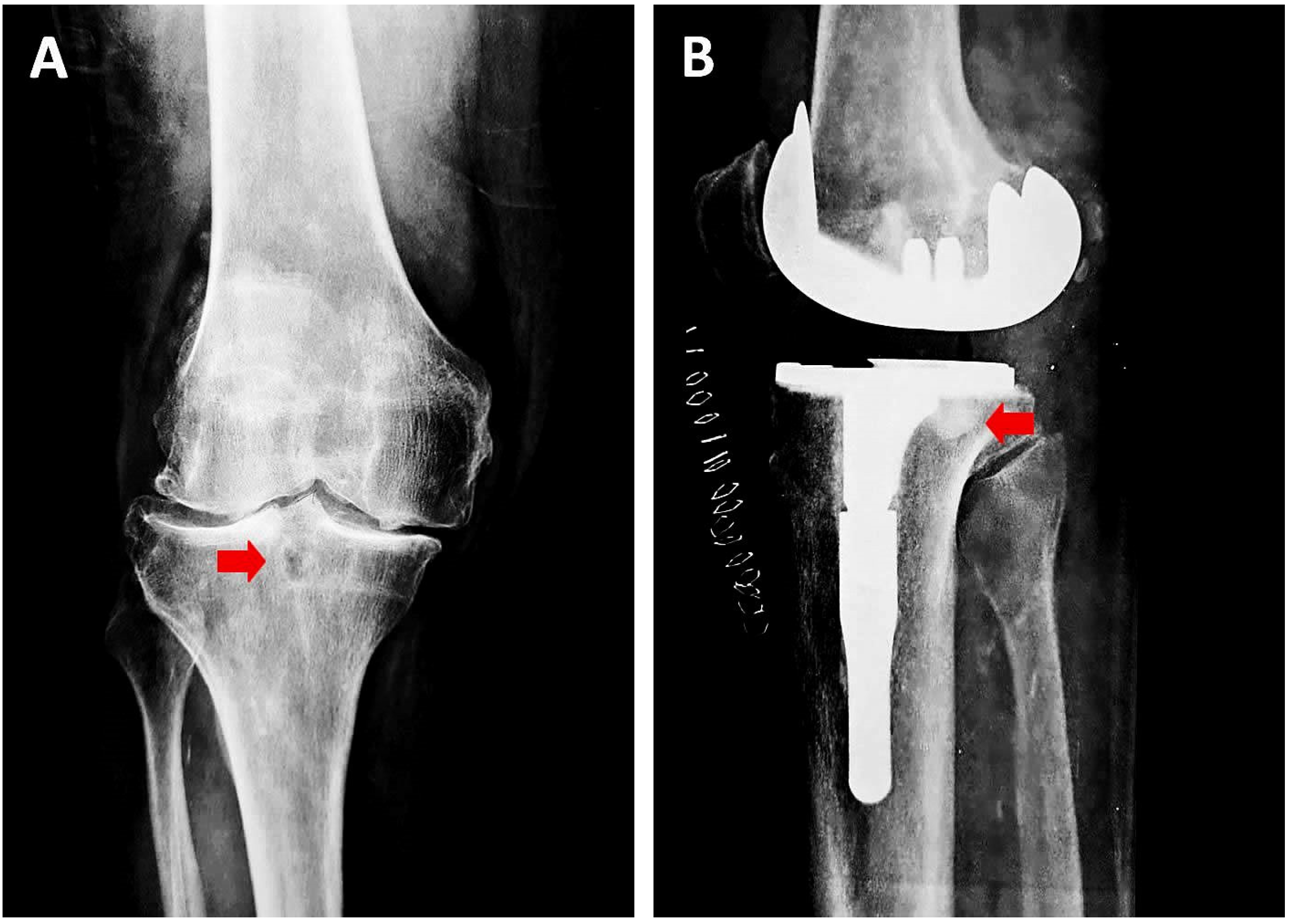 JCM Free Full Text Subchondral Bone Cyst Development In JCM Free Full Text Subchondral Bone Cyst Development In