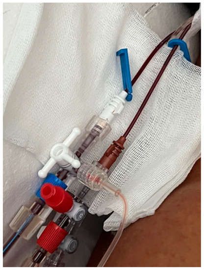 Slow Continuous Ultrafiltration in Regional Citrate Anticoagulation ...