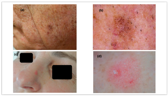 Dermoscopy of Actinic Keratosis: Is There a True Differentiation ...