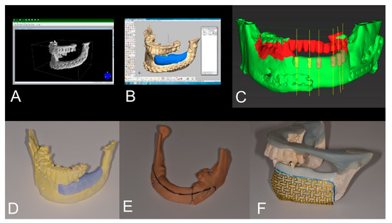 Towards Optimum Mandibular Reconstruction for Dental Occlusal ...