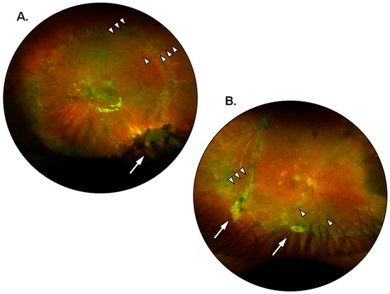 Applications of Human Amniotic Membrane Patching Assisted Vitrectomy in ...