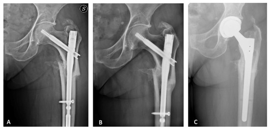 Clinical Outcomes and Complication Rate after Single-Stage Hardware ...