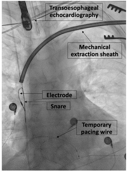 Success and Complication Rates of Transvenous Lead Extraction in a ...