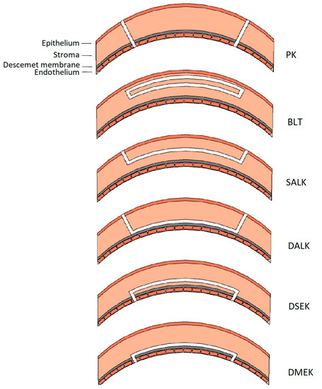 Bowman Layer Transplantation for Treating Keratoconus—Preliminary Findings