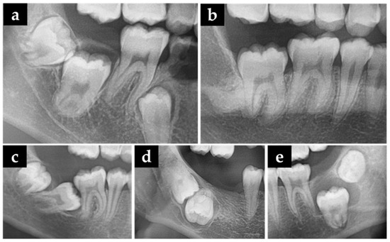 Radiographic Features of Mandibular Second Molars with Eruption ...