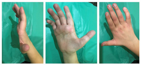 Amyotrophic Lateral Sclerosis Mimic Syndrome in a 24-Year-Old Man with ...