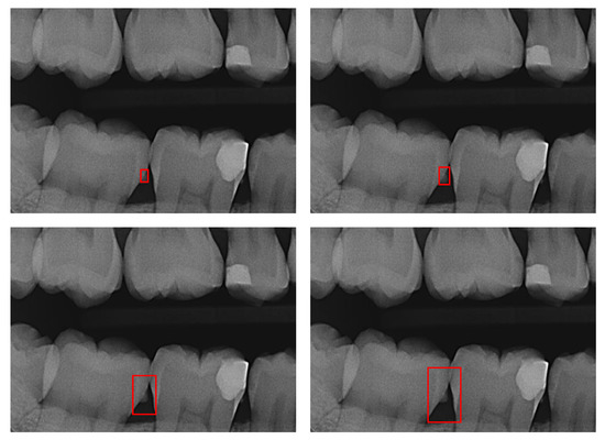 Impact of Noisy Labels on Dental Deep Learning—Calculus Detection on ...