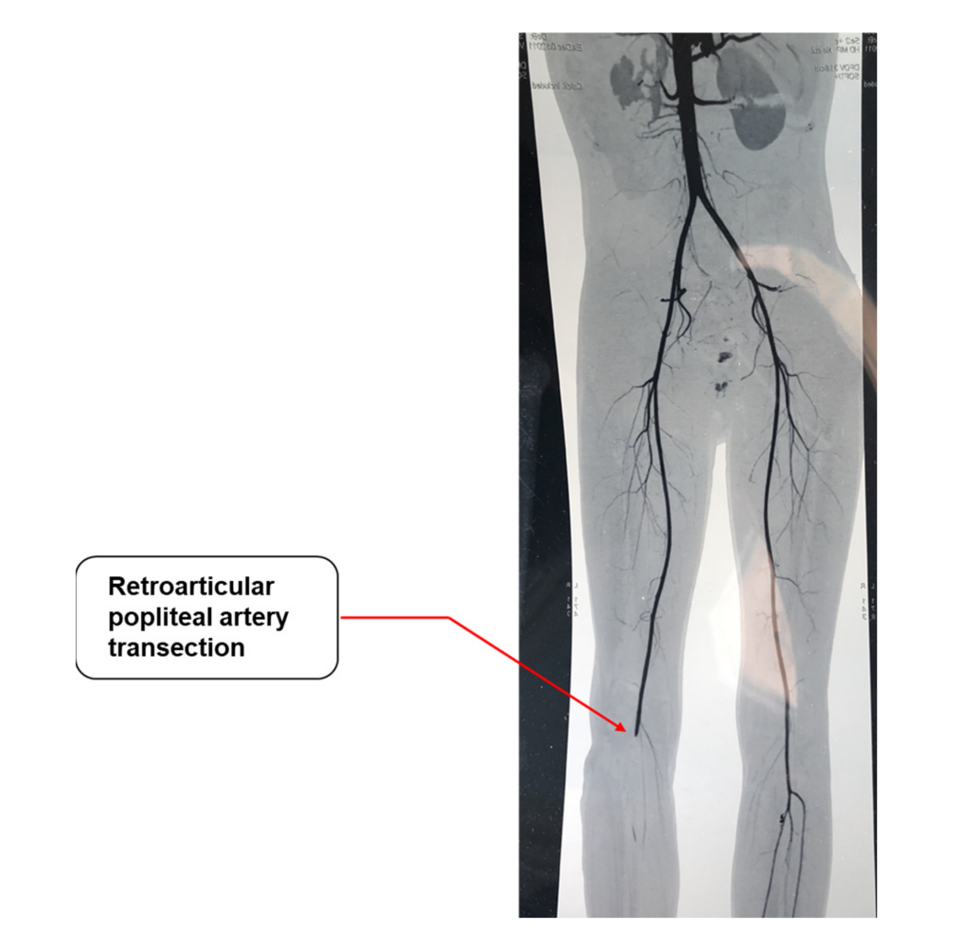 Penetrating Vascular Injuries Of The Lower Limbs After Stab Wounds Penetrating Vascular Injuries Of The Lower Limbs After Stab Wounds