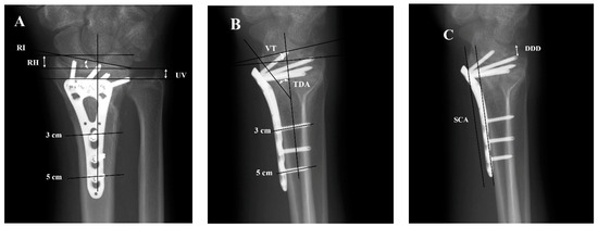 Radiographic Analysis in Extra-Articular and Intra-Articular Distal ...
