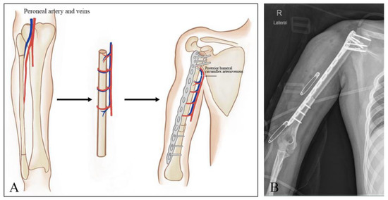 A Retrospective Study of the Functional Outcomes in Patients with ...