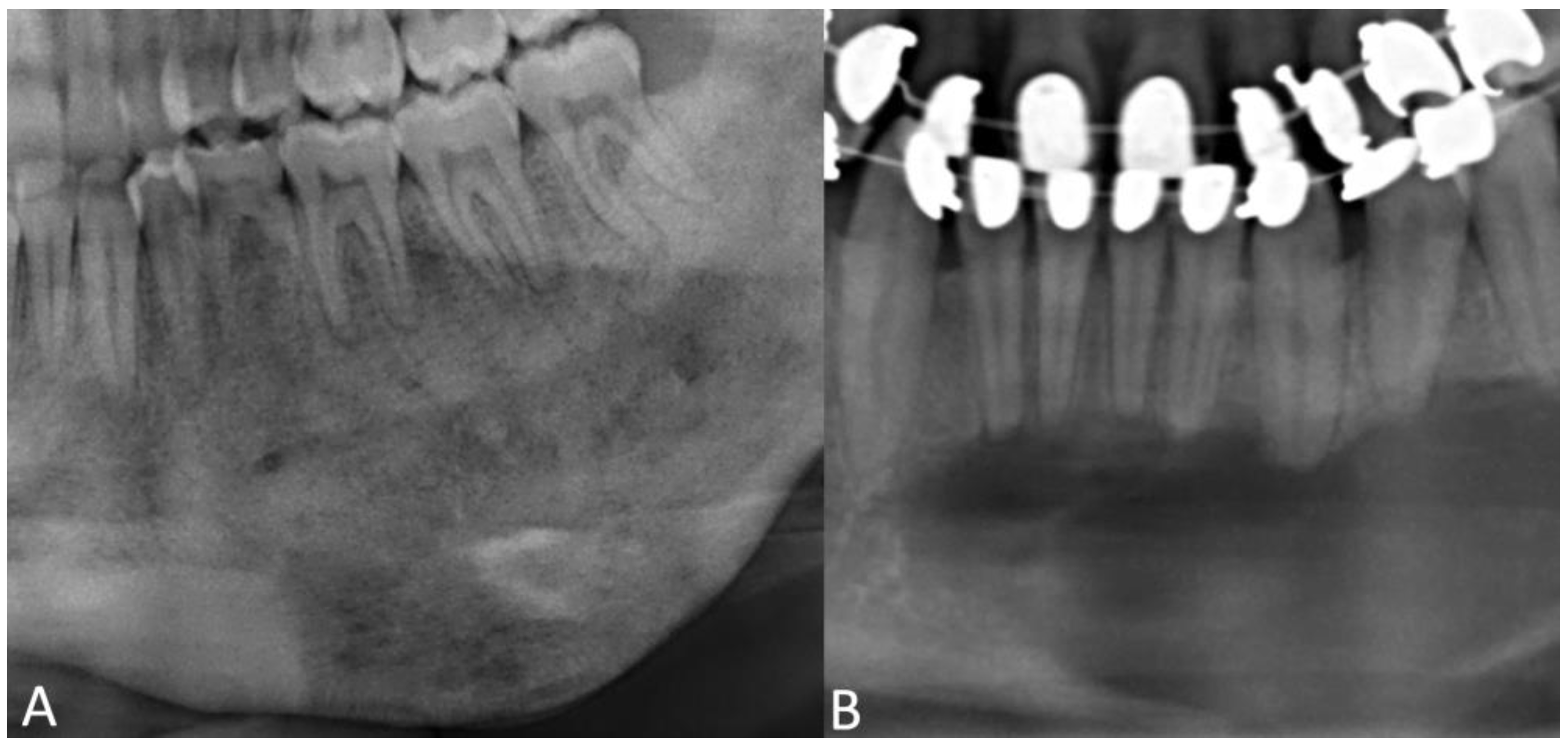JCM Free Full Text Fibrous Dysplasia Of The Jaw Advances In JCM Free Full Text Fibrous Dysplasia Of The Jaw Advances In