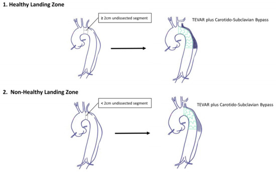 Long-Term Outcomes in Thoracic Endovascular Aortic Repair for ...