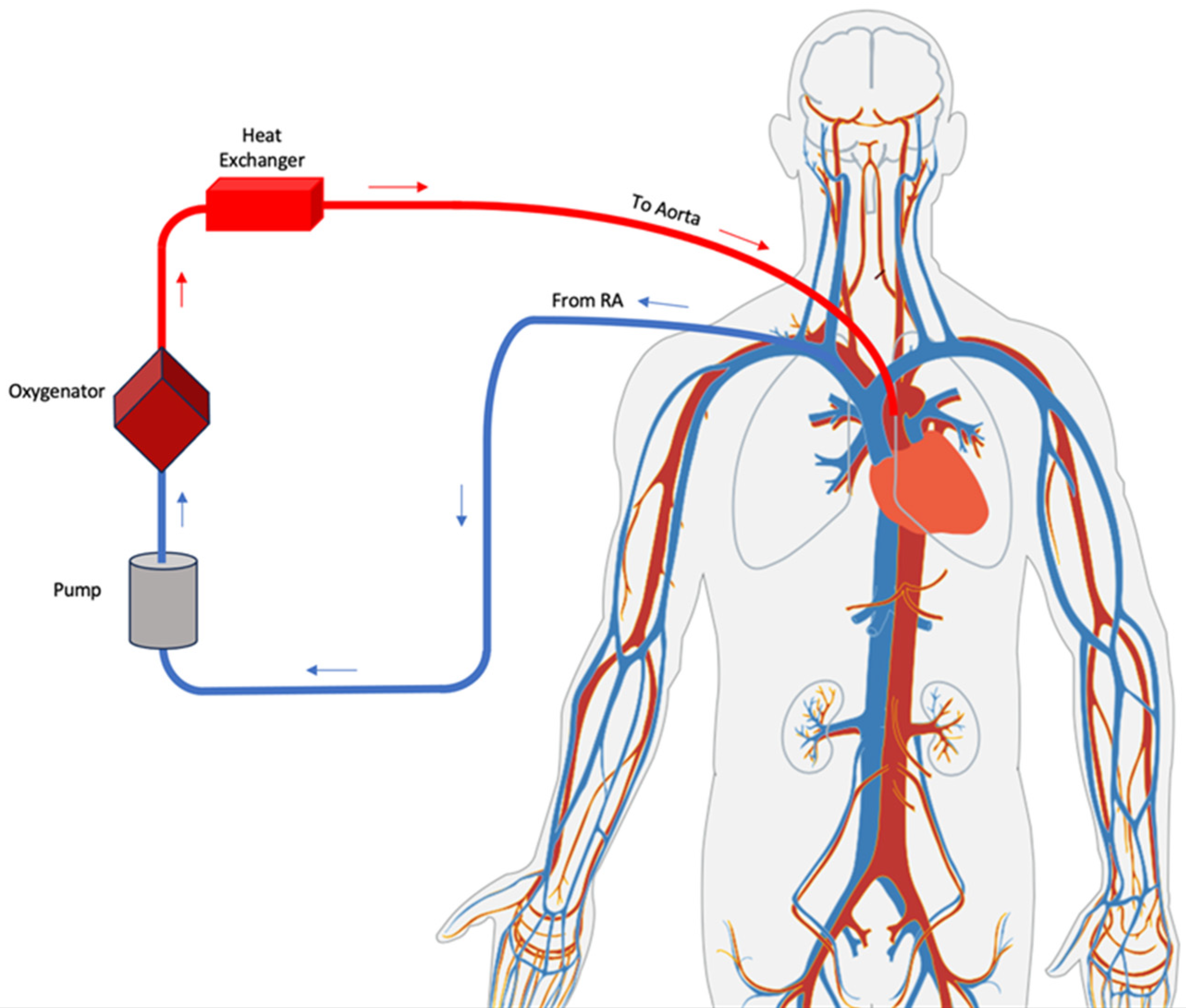 Extracorporeal Membrane Oxygenation VA ECMO In Management Of Extracorporeal Membrane Oxygenation VA ECMO In Management Of