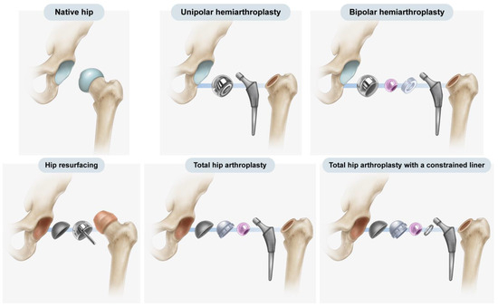 Deviation of Latitude Cut: A Simple Sign to Differentiate Total Hip ...