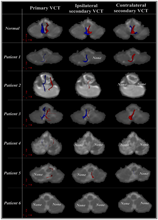 Injury of the Vestibulocerebellar Tract and Signs of Ataxia in Patients ...
