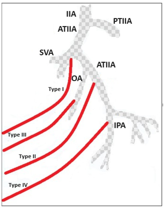 Jcm Free Full Text Prostate Artery Embolization In The Treatment Of
