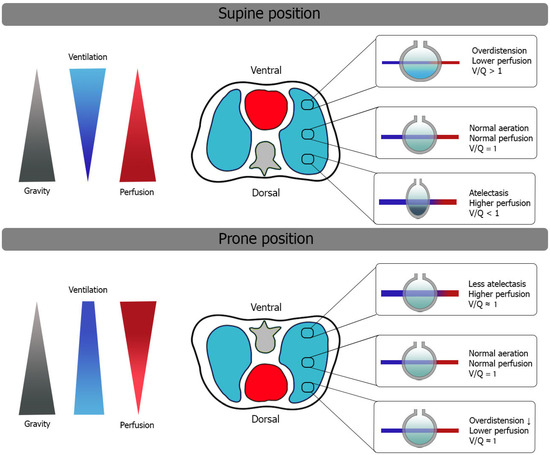 JCM | Free Full-Text | Prone Positioning and Molecular Biomarkers in ...