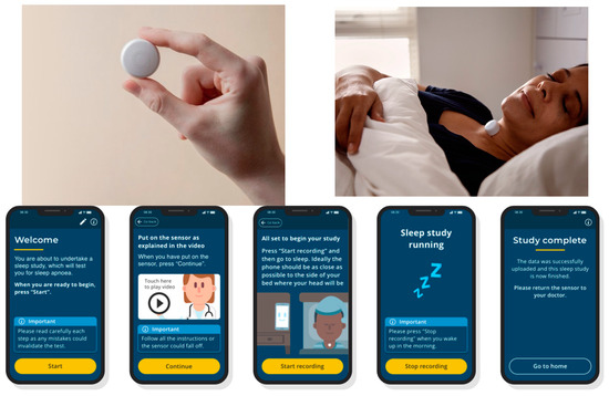 Validation of a Wearable Medical Device for Automatic Diagnosis of OSA ...