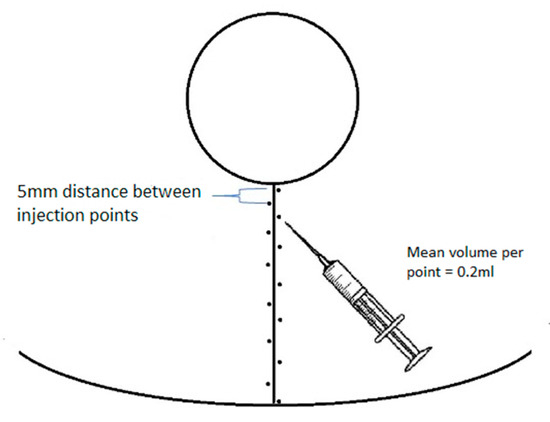 Do Intraoperative Platelet-Rich Plasma Injections Influence the Final ...
