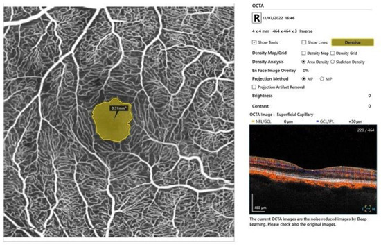 Retinal Microvasculature in Systemic Sclerosis Patients and the ...