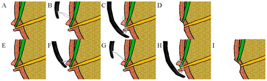 New Method of Papillectomy May Decrease Recurrence: Anchoring Method ...