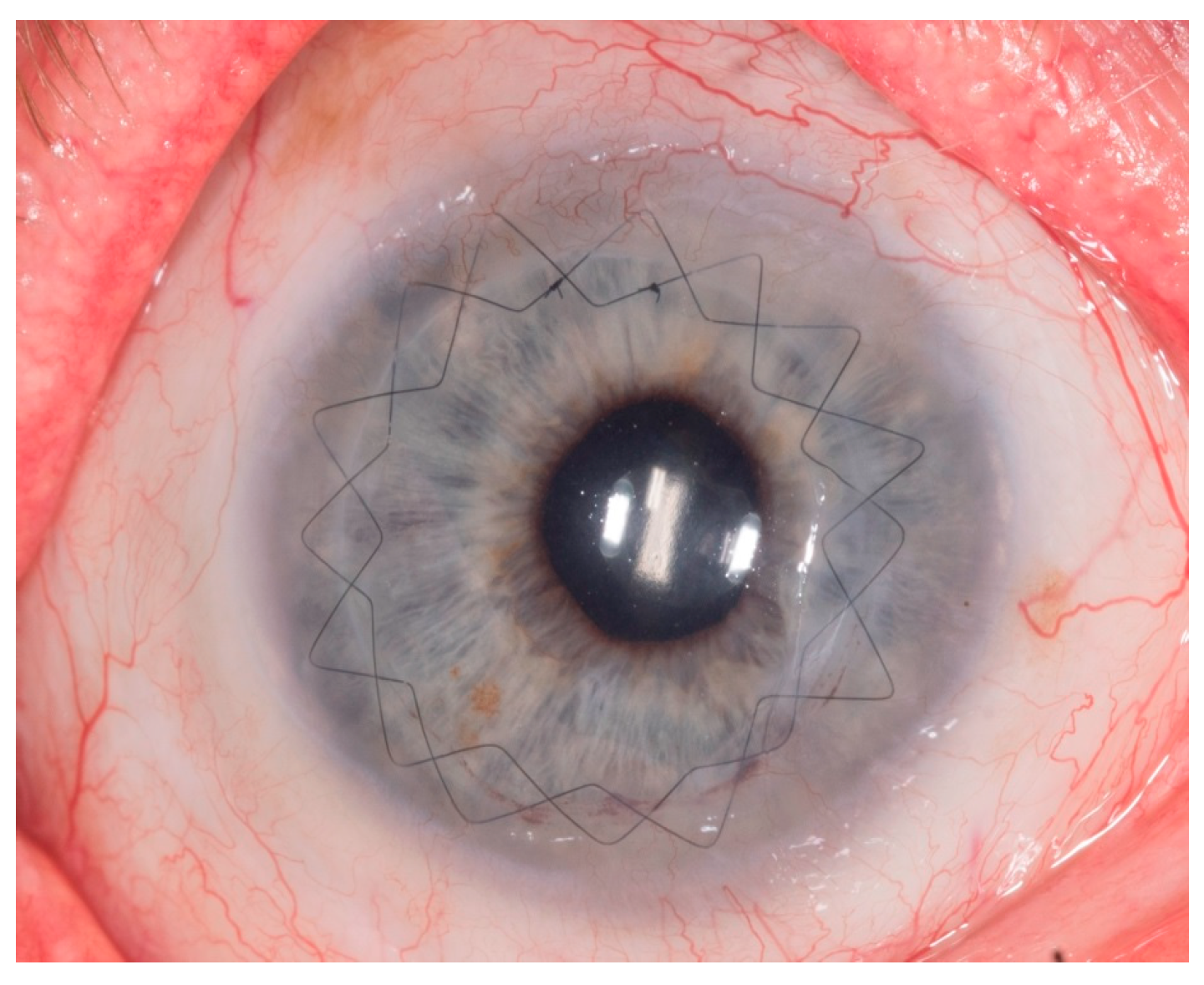 JCM | Free Full-Text | Simultaneous Muraine Sutures and Excimer Laser ...