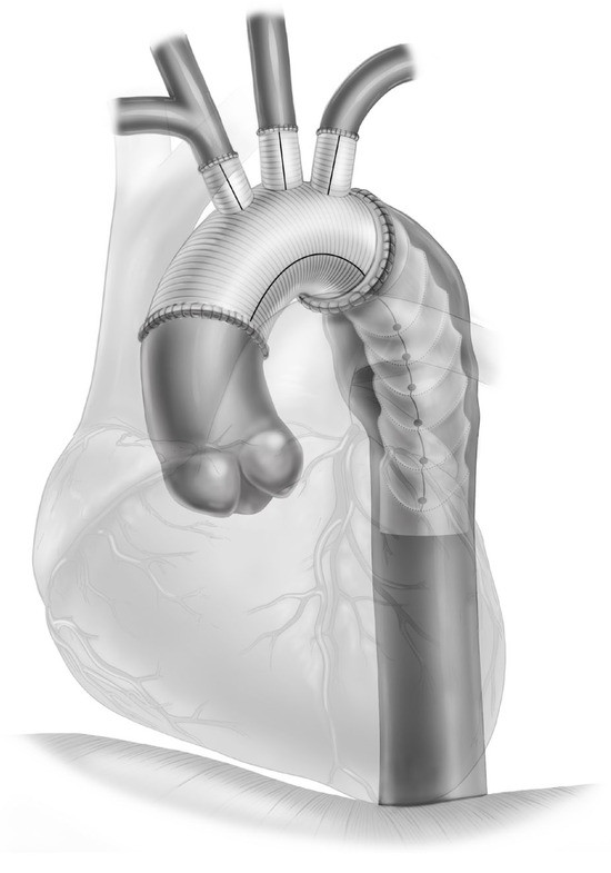 Surgical Strategies in Reoperation of the Proximal Aorta and Arch for ...