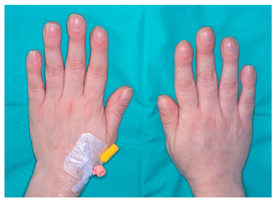 Cardiac Sarcoma Mimicking Libman–Sacks Endocarditis in a Patient with ...