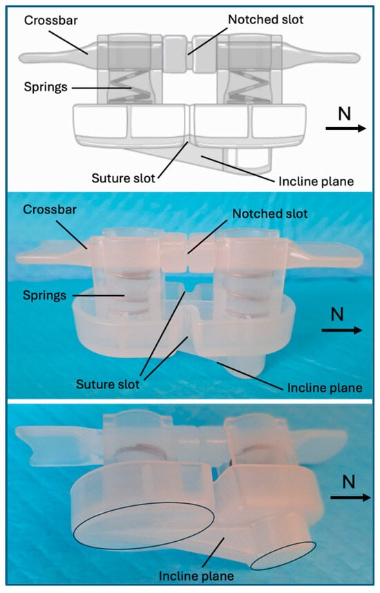 A Novel Suture-Based Vascular Closure Device to Achieve Hemostasis ...