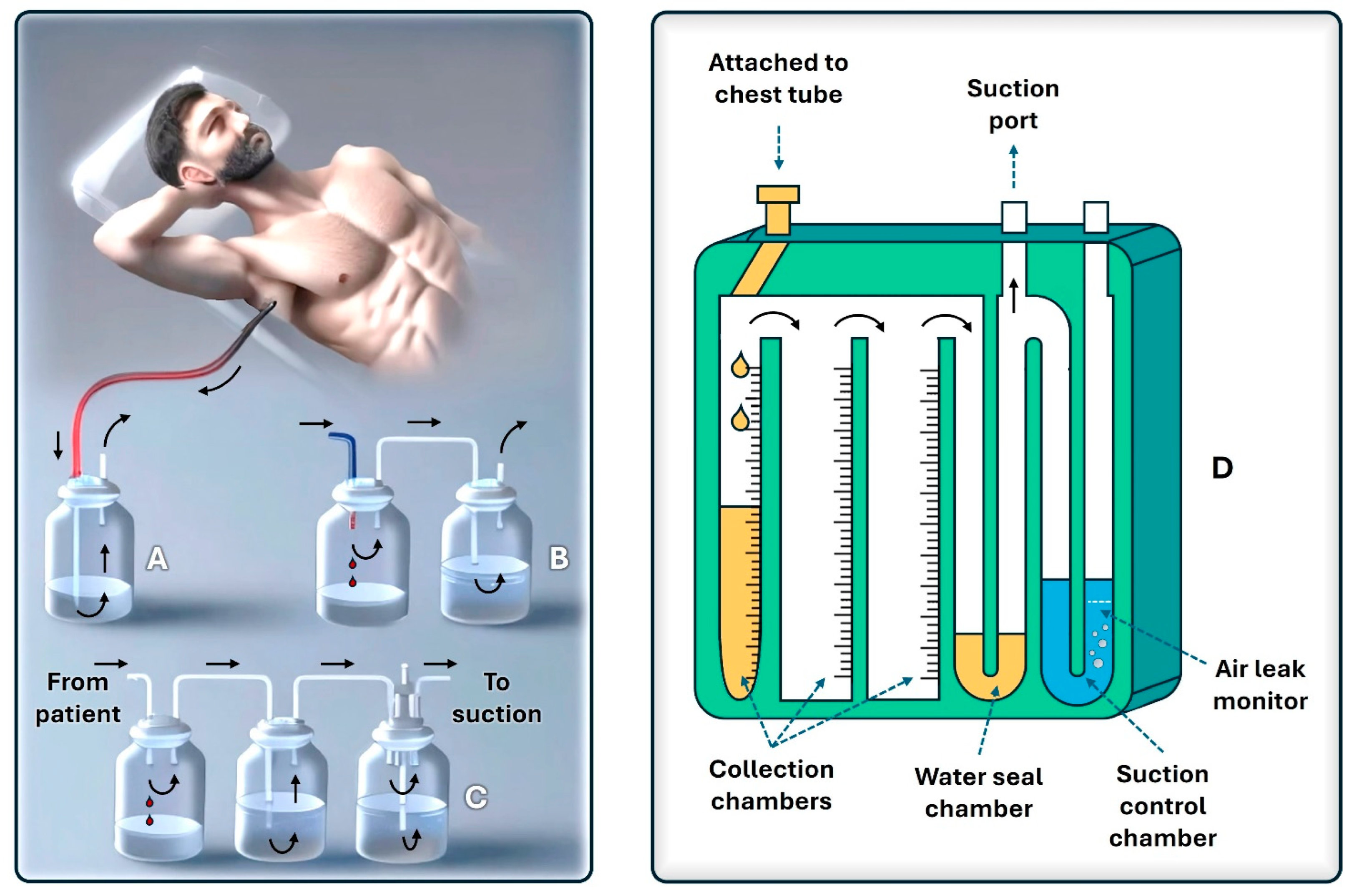 Water Seal Vs Suction Chest Tube The Tube Water Seal Vs Suction Chest Tube The Tube