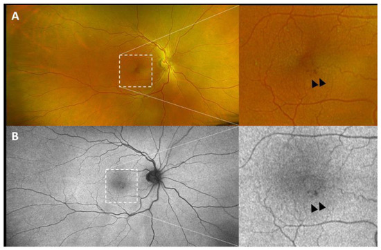 Perifoveal Exudative Vascular Anomalous Complex (PEVAC): Retinal ...
