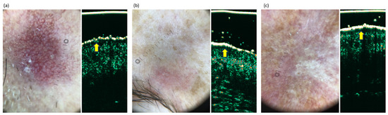 Automatic Assessment of AK Stage Based on Dermatoscopic and HFUS ...