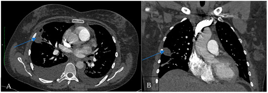 Hampton’s Hump—A Rare Radiological Feature in Patients with Pulmonary ...
