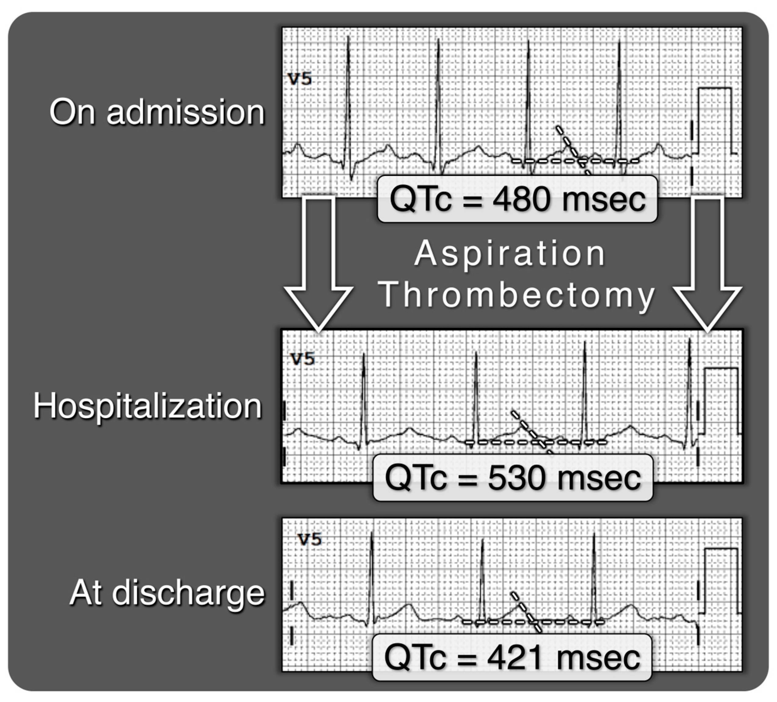 QTc Prolongation as a Diagnostic Clue in Acute Pulmonary Embolism