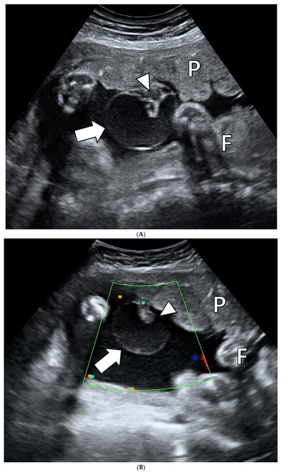 Subchorionic Placental Cyst in a Woman with Fetal Growth Restriction: A ...
