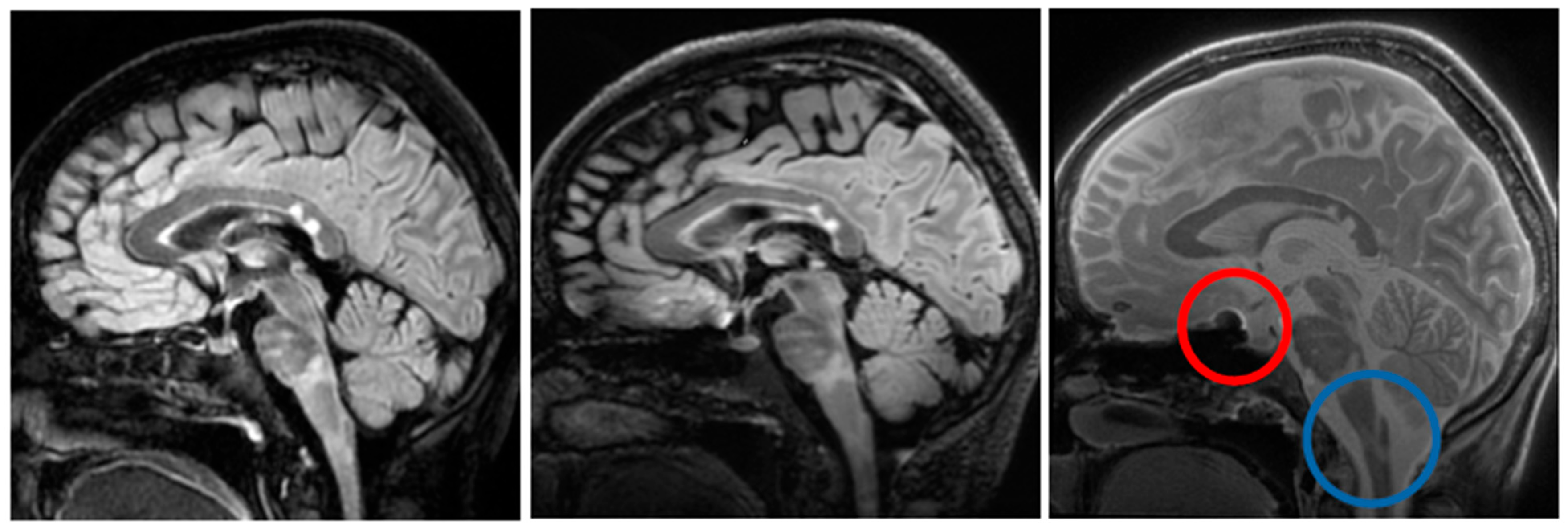 Magnetisation Transfer 3D-Radial Zero Echo Time MR Imaging at 7T