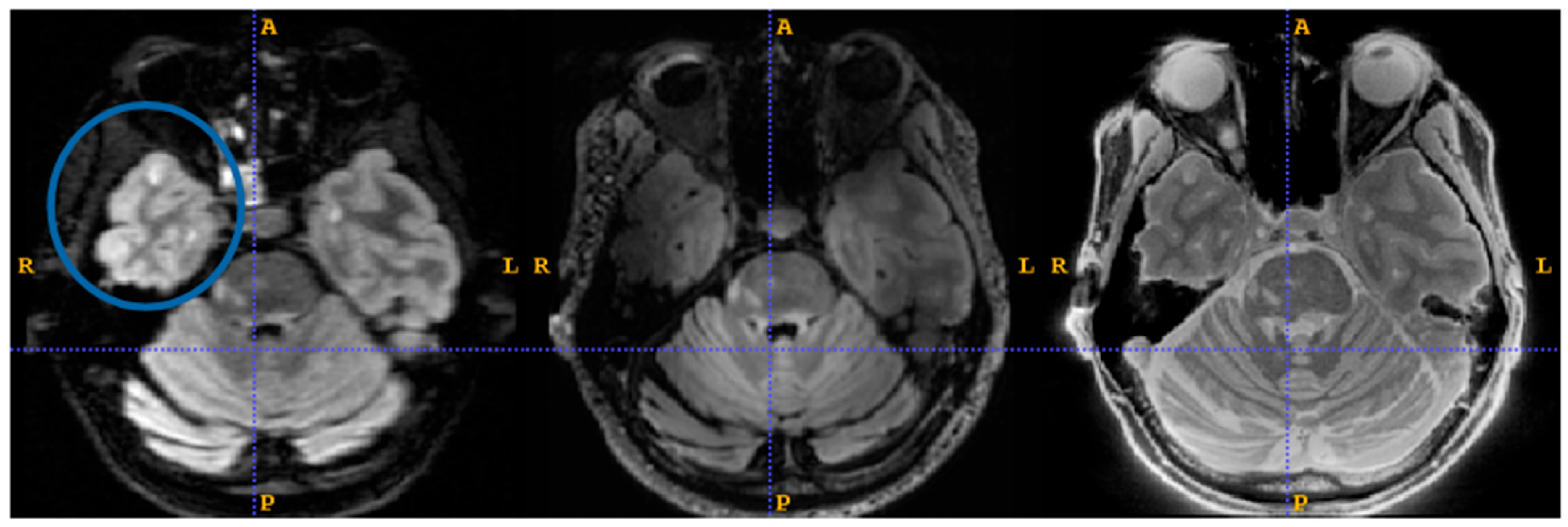 Magnetisation Transfer 3D-Radial Zero Echo Time MR Imaging at 7T
